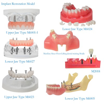 Dental Typodont Implant Restoration Overdenture Model Demo Practice ...