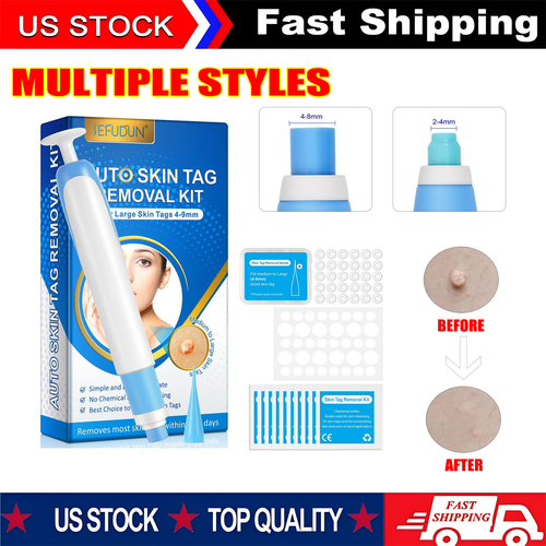 Auto Micro Skin Tag Remover Device Kit Painless Removal Wart Removal ...
