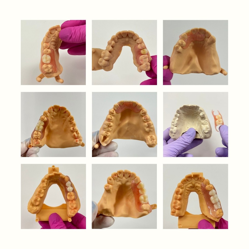 Nesbit, Flexi Flipper, Molar Flipper, Missing Canine Tooth, Flipper ...
