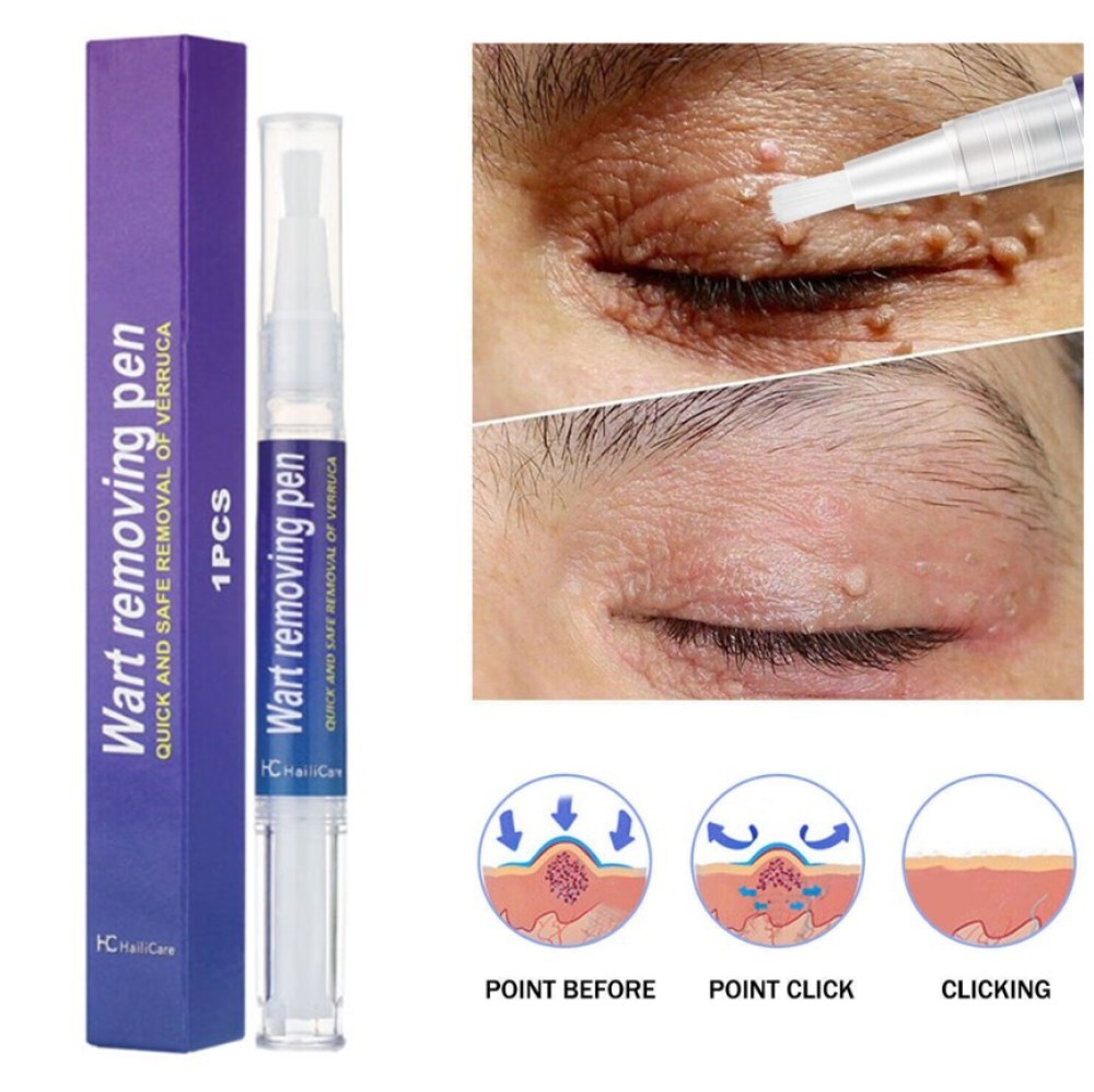 10/5x 12 Hours Wart Remover Pen Skin Tag Mole Remover Eliminate Foot ...