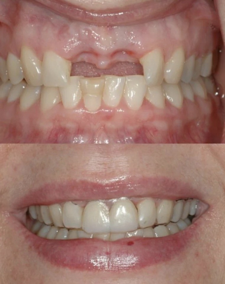 Retainers With Teeth, Affordable Way To Fill In Your Smile, with 1-3 ...