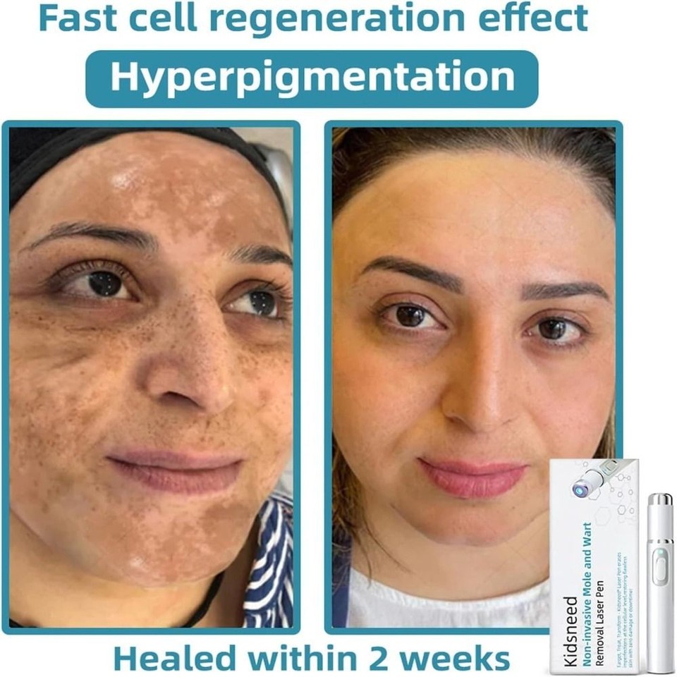 Skin Spots Removal Mole Remover Anti Varicose Wart Removal Pen for ...