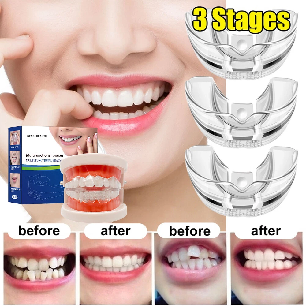 Retainer Designs For Teeth Prices