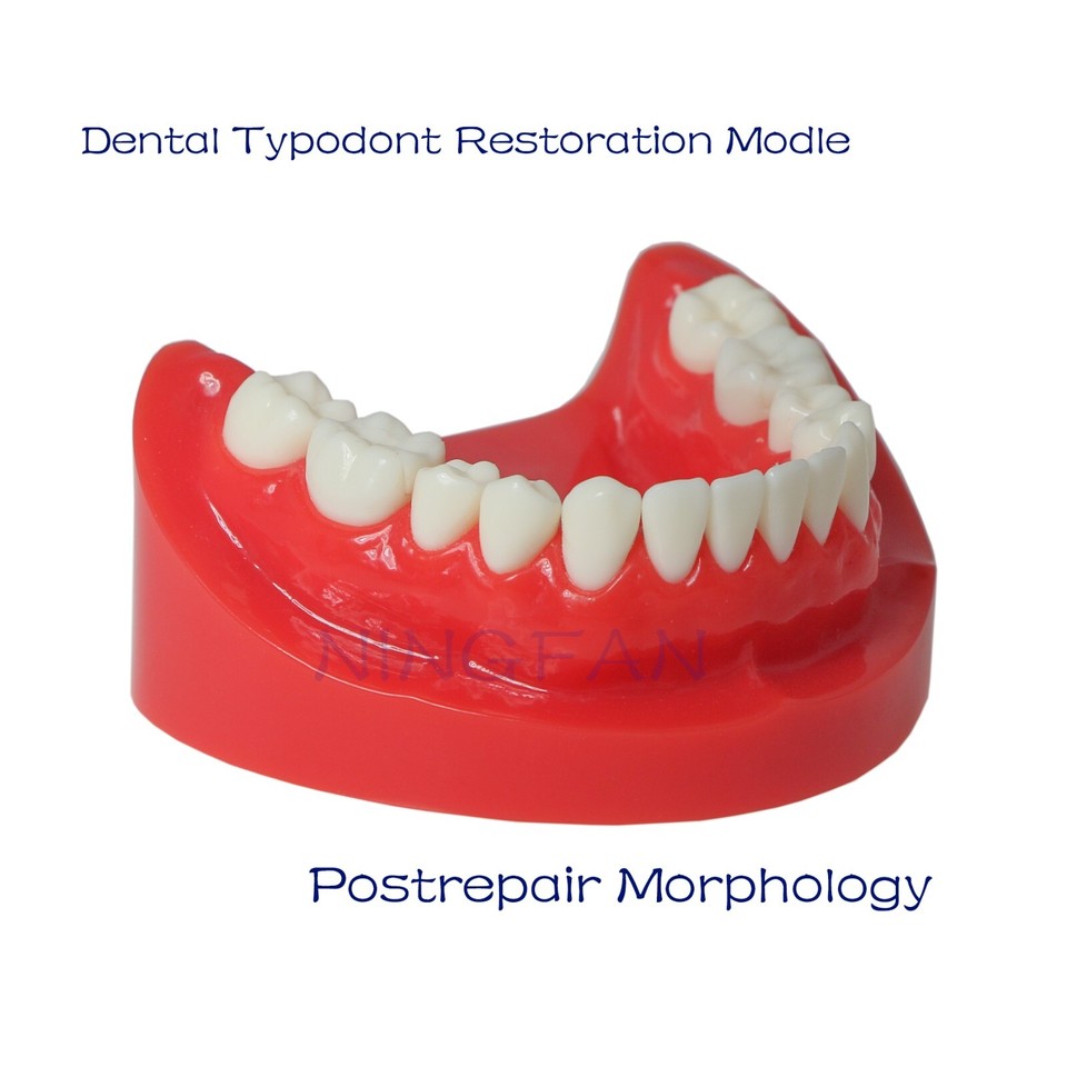 Dental Typodont Restoration Model, Tooth Patch, Crown, Bridge Repair ...