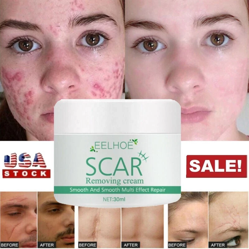 Acne Scars Removal Cream