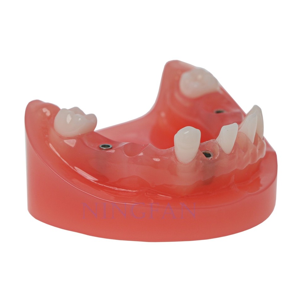 Implant Prosthetic Kit For Hiossen Osstem,Dental TS Bone Profiler ...