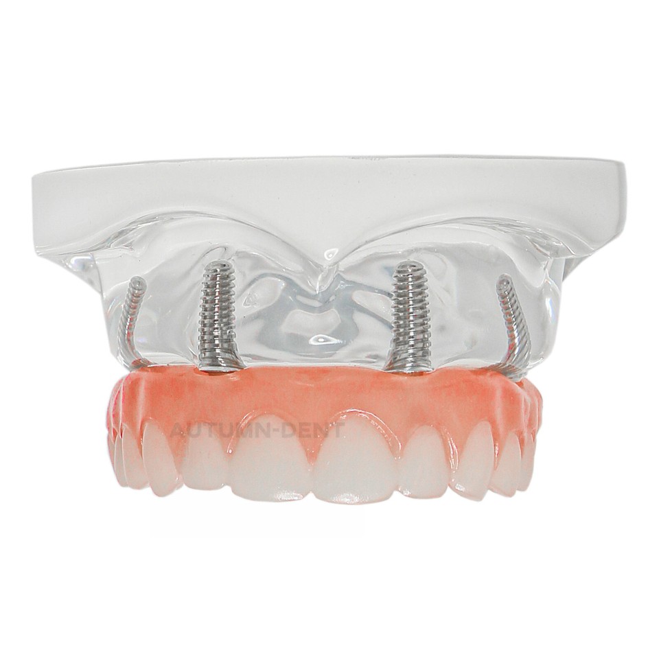 Dental 4 Implants Upper&Lower Demo Implant Teeth Model Restoration ...