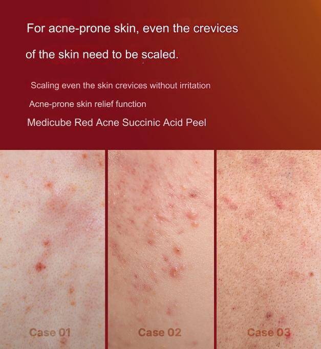 Medicube Red Acne Care Succinic Acid DeadSkin Sebum Control Blackhead ...