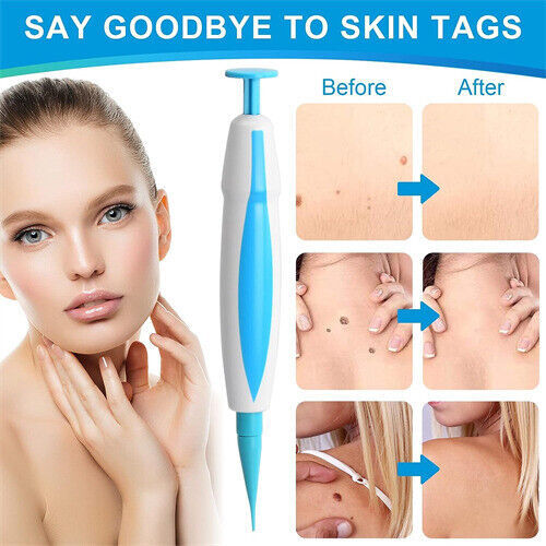 Auto Micro Skin Tag Remover Device Kit Safe Painless Removal Band Tool ...