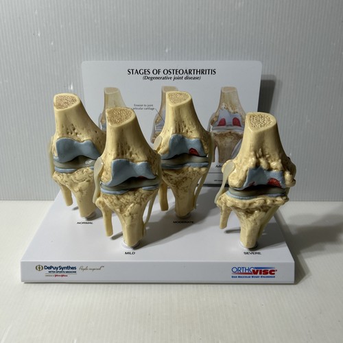 GPI ANATOMICALS 4 Stage Osteoarthritis Knee Set Anatomy Model Patient ...