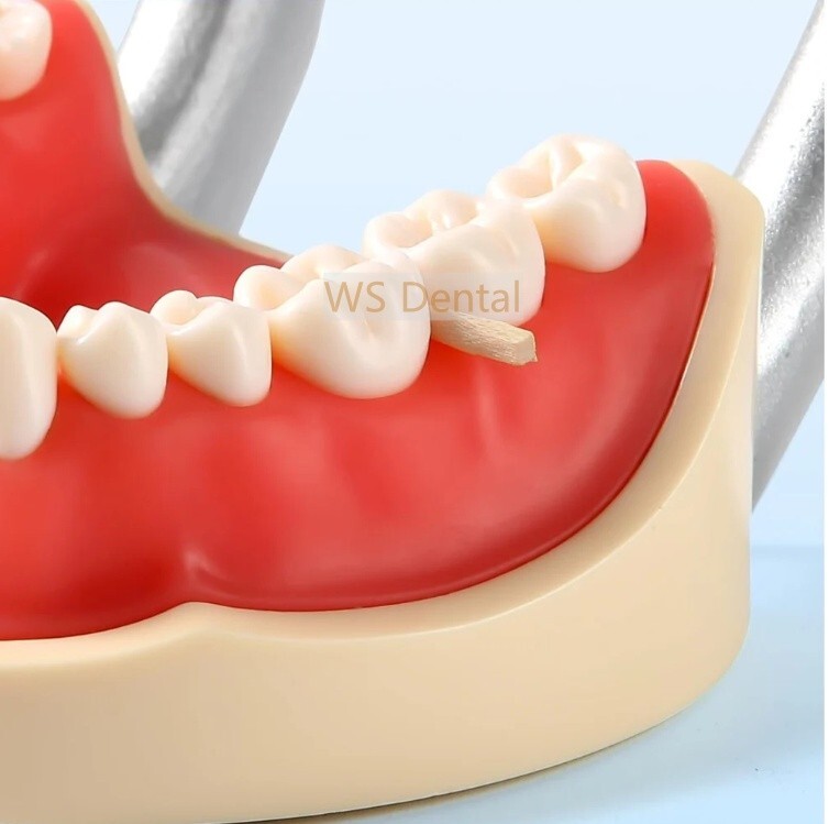 400Pc Dental Wooden Wedges Interdental Restoration Contoured Wood ...