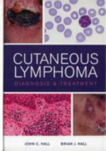 Cutaneous Lymphoma : Diagnosis and Treatment by Brian J. Hall (2012 ...