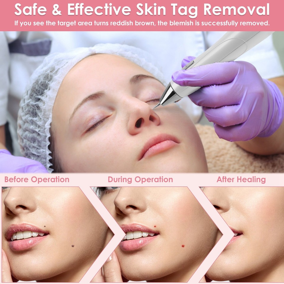 Skin Tag Remover Skin Tag Repair Kit Tattoo Freckle Wart Mole Remover ...