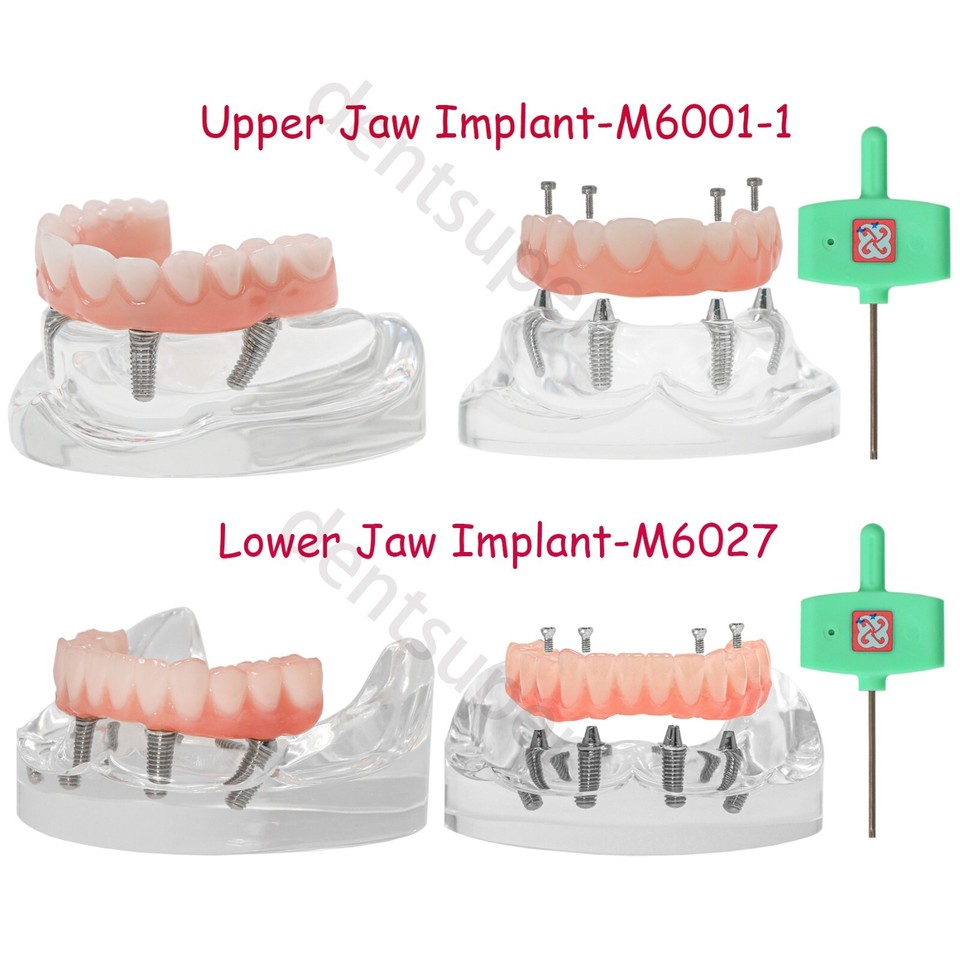 Dental Typodont Implant Model All on 4 Overdenture Upper/Lower Jaw ...