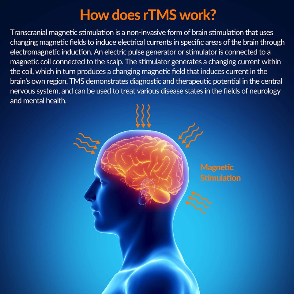 Rtms for Stroke Insomnia Depression Treatment Transcranial Magnetic ...