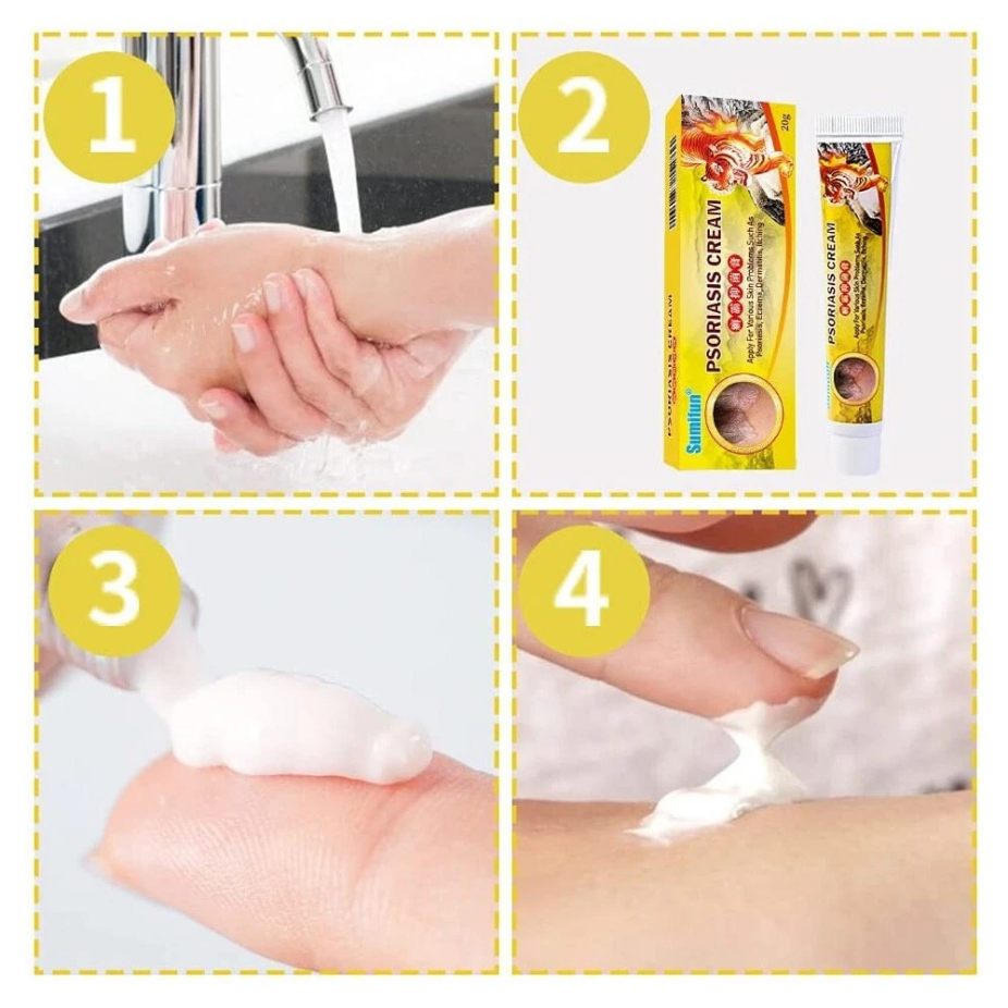 Health Care Psoriasis Cream Eczema Ointment Scalp Psoriasis Hand Tinea ...