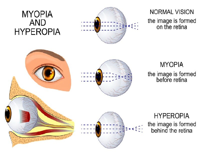 Human Myopia & Hyperopia Eye 5mm thick Plastic Poster Ready to Hang ...