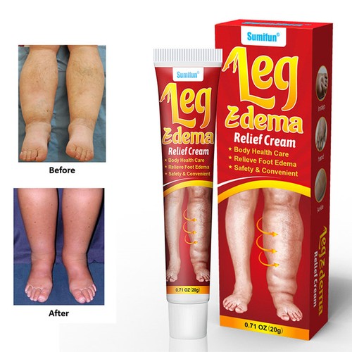 20G Leg Edema Relief Cream For Arm Foot Edema Swelling Pain Relief ...
