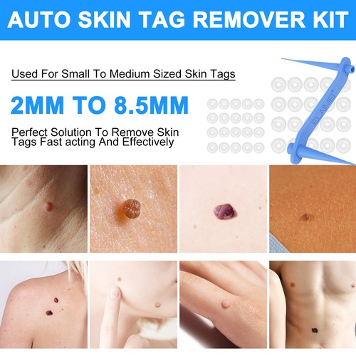 2in1 Micro Skin Tag Remover tool Kit Painless Wart Acne Skin Tags ...