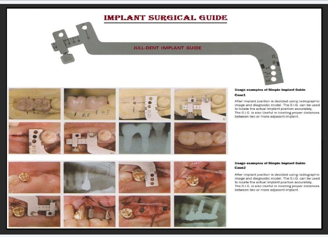 IMPLANT SURGICAL GUIDE, GUIDE FOR MAINTAINING PROPER DISTANCE BETWEEN ...