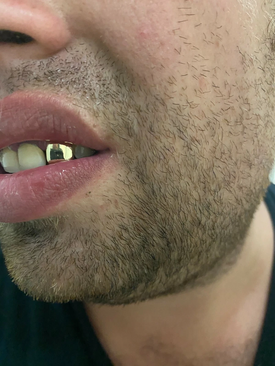Gold Teeth 2