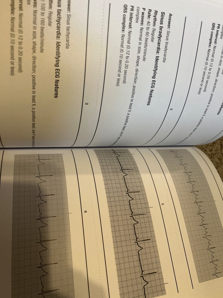 ECG Workout : Exercises in Arrhythmia Interpretation by Jane Huff (2011 ...
