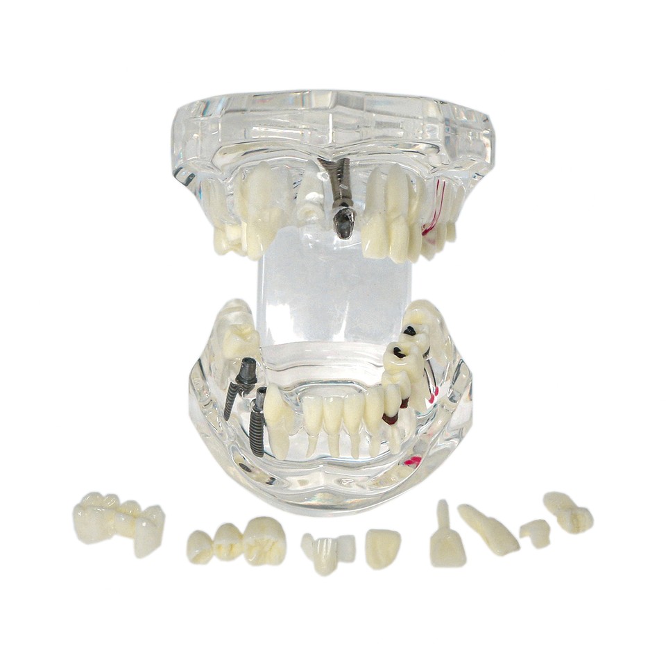 Multi Types Dental Typodont Teeth Model Implant Pathological Perio ...