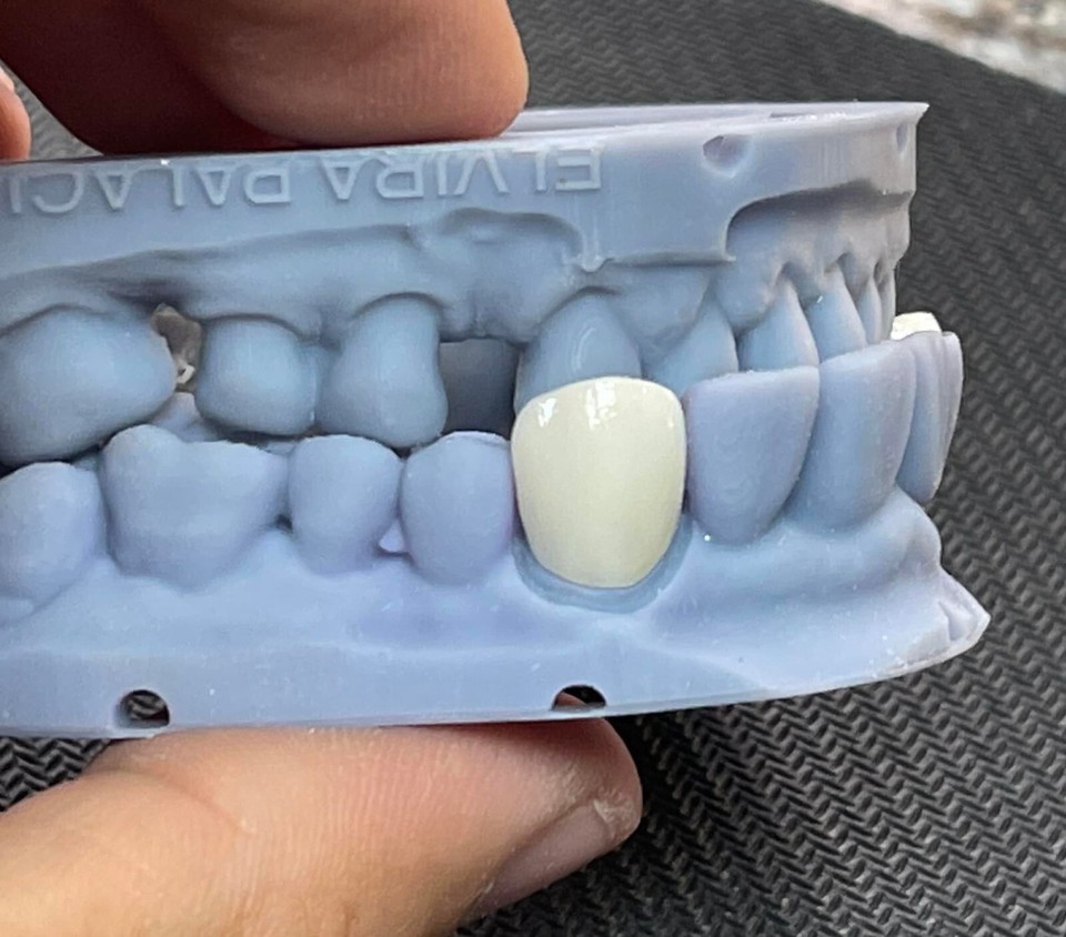 DLP SLA LCD 3d printer temporary teeth resin .. | eBay
