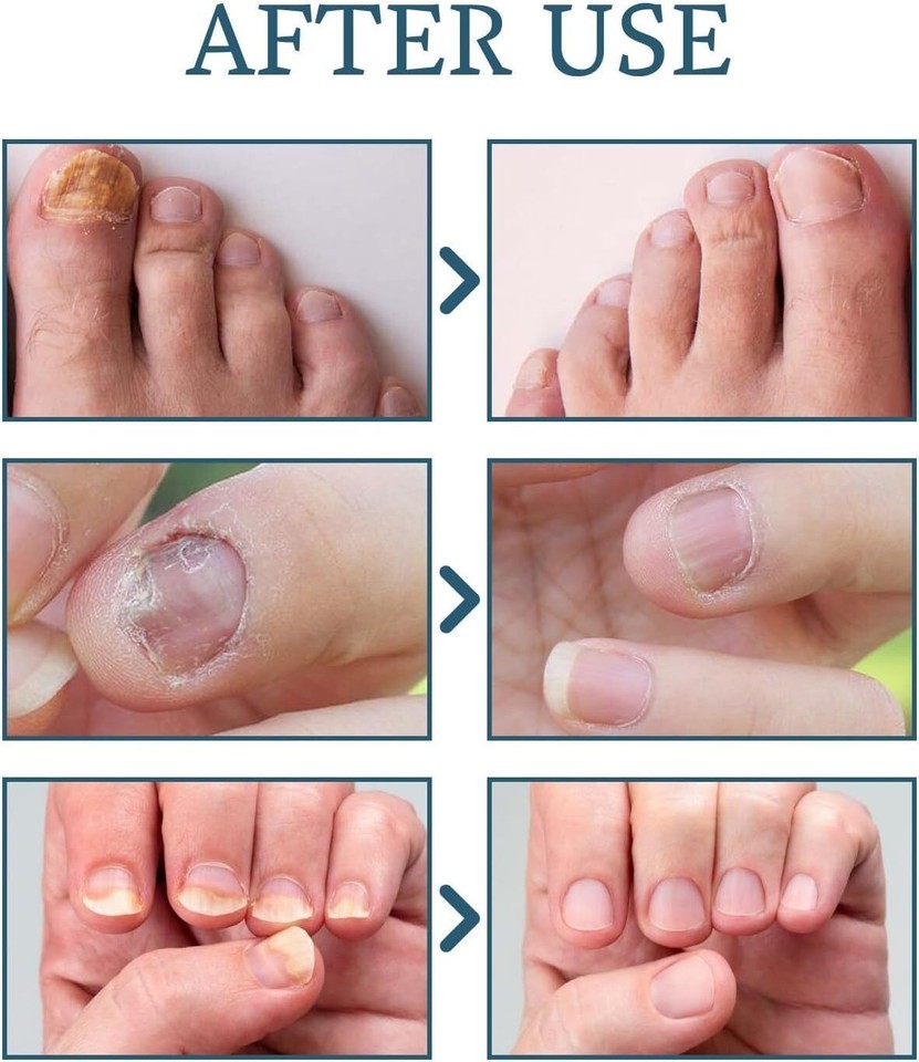 Fungal Nail Treatment - Extra Strong Nail Fungus Treatment for Toenail ...