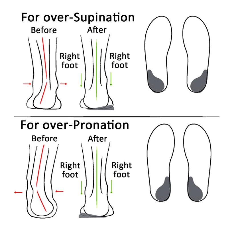 3Pairs Orthopedic Insoles Heel Inserts Shoe Wedge Silicone Corrective ...