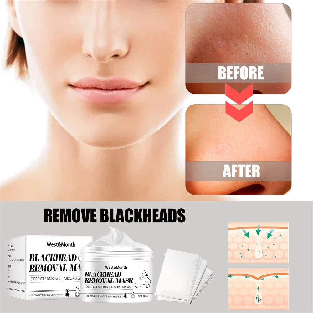 Blackheads Removal Cream