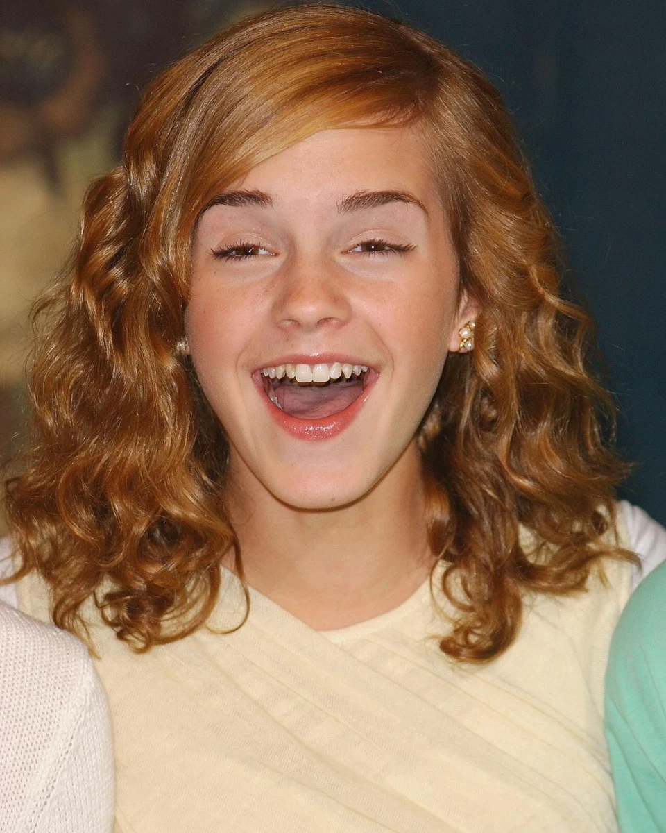 Emma Watson Braces Before After