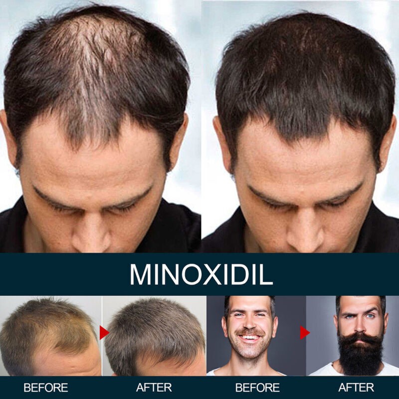 Extra Strength Hair Regrowth Treatment 5% Minoxidil Spray for Men 10Month Supply | eBay
