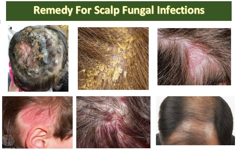 Scalp Ringworm 2: Scalp Tinea Capitis (scalp Ringworm). (Source: