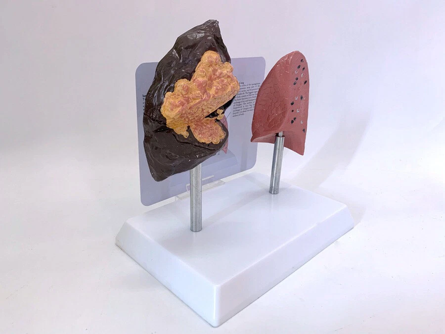 Smokers Lung Comparison