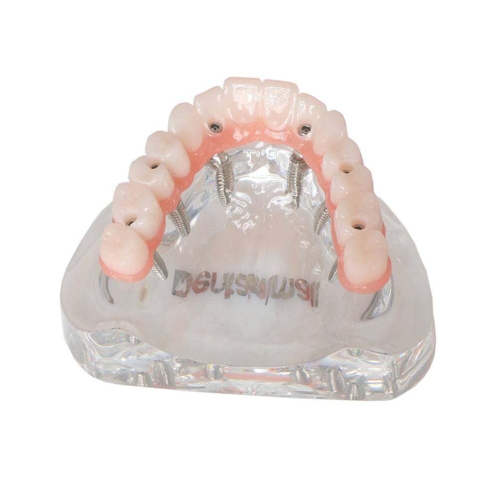 US Dental Overdenture Implant Teeth Model Upper/Lower Jaw Type With 4/6 ...