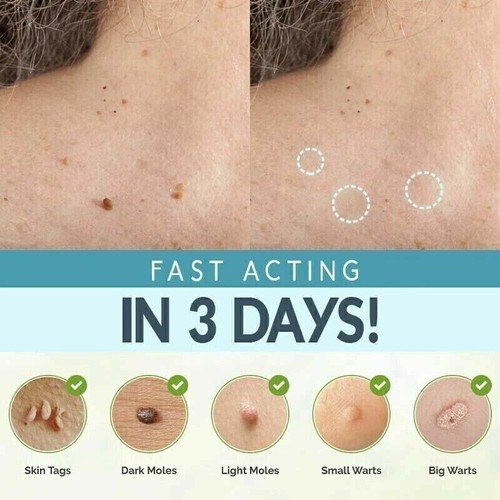2 X SAFE &FAST SKIN TAG REMOVER LIQUID MOLE WART ACNE PIMPLE PATCH ...