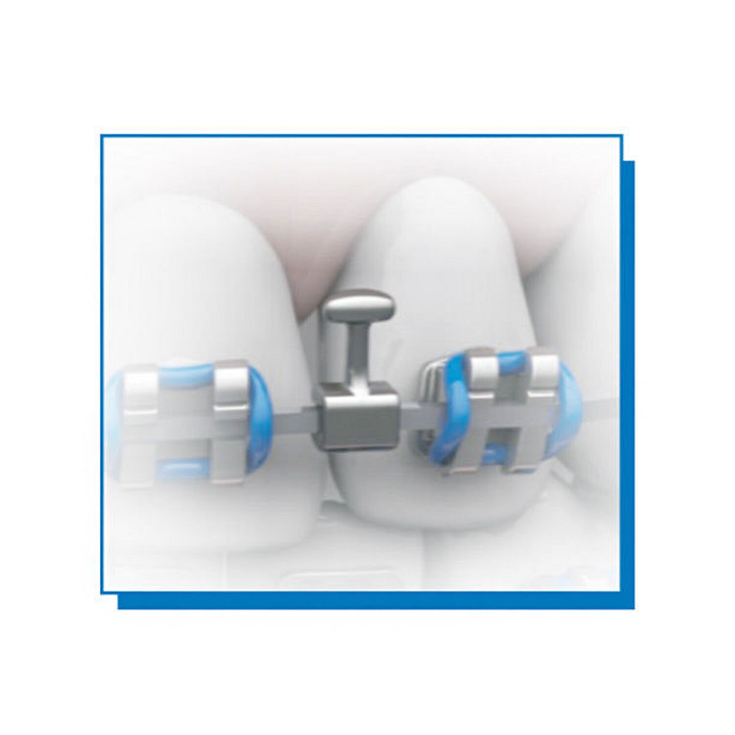 Morelli Dental Orthodontic Crimpable Split Hooks Straight Universal ...