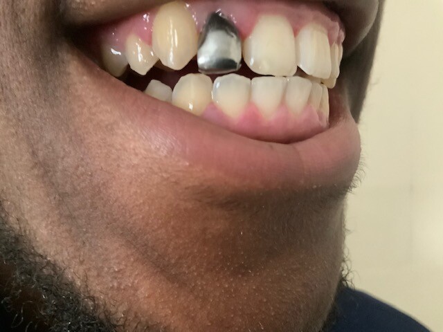 Silver Front Tooth