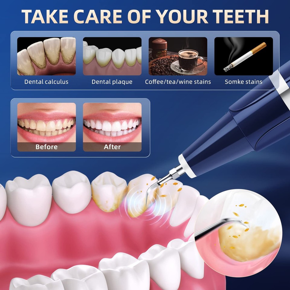 Plaque Remover for Teeth - Tartar Remover for Teeth, Dental Calculus ...