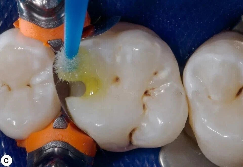 Coltene One Coat Bond SL Refill Solvent Free Dental Bonding | eBay