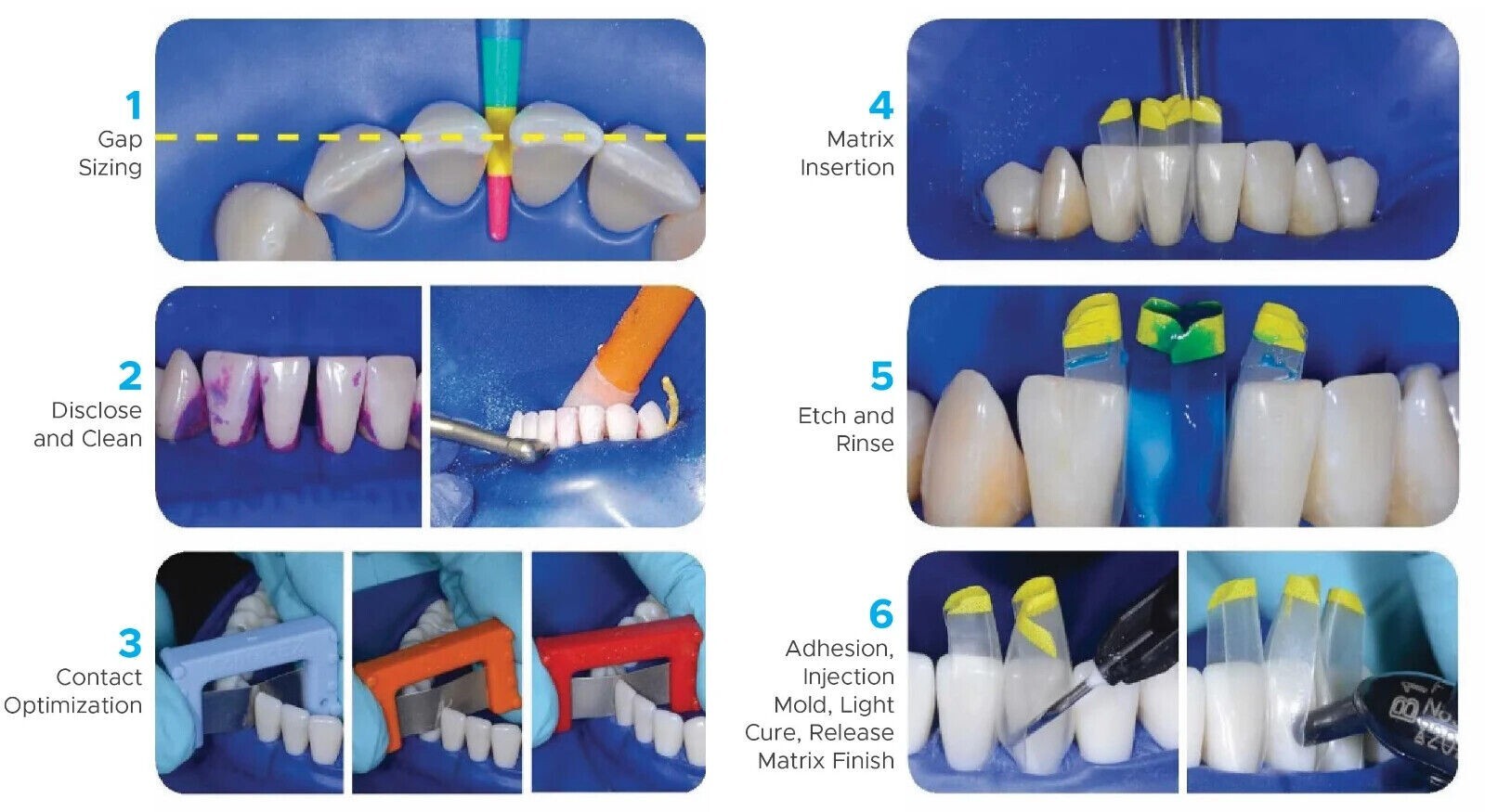 BioClear Black Triangle kit Matrix System For Anterior Black Triangles ...