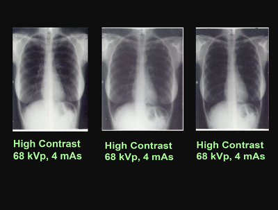 Radiography Pixel Density Radiographic Receptors