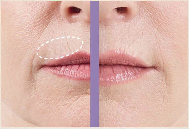 TRIPLE SMOOTH UPPER LIP WRINKLE CREAM REMOVE WRINKLES ON THE LIPS | eBay