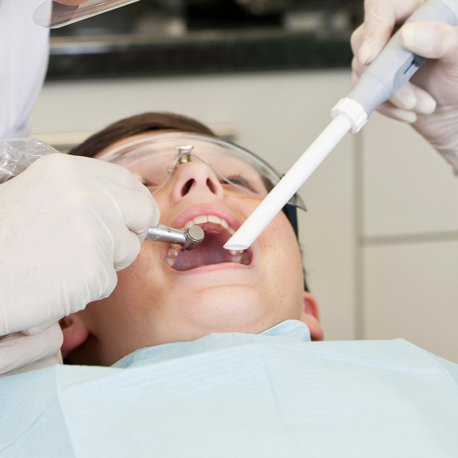 2000PCS JMU Dental Surgical HVE High Volume Evacuation Suction Tips ...