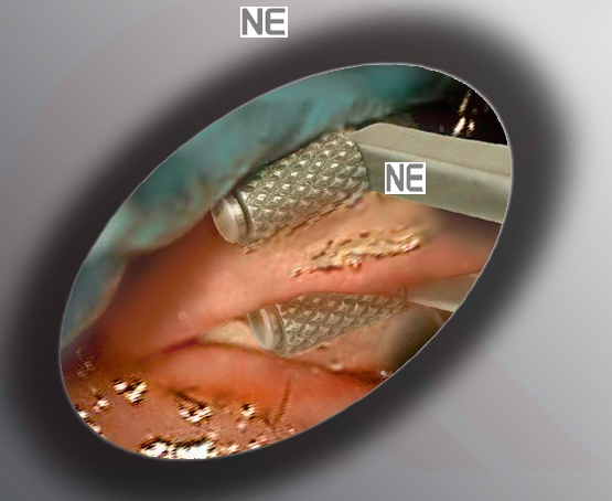 SS Meibomian Gland Rollers Squeeze Expresser Eyelid Deep Meibum Remove ...