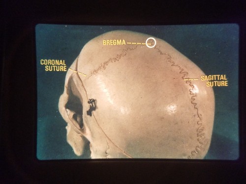 XAZ09 35mm Slide Photo Vintage CORONAL SUTURE BREGMA SAGITTAL SUTURE | eBay