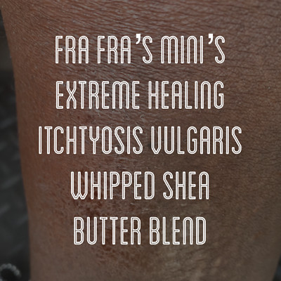 Fra Fra's Mini's | Premium EXTREME Itchtyosis Vulgaris Shea Butter ...
