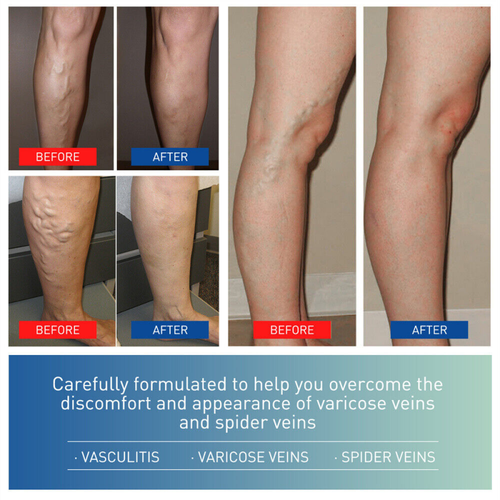 Varicose Veins Treatment Cream Vasculitis Phlebitis Spider Relief Pain ...