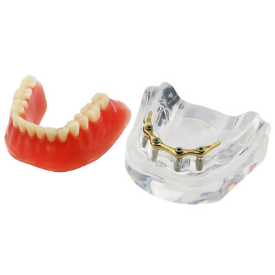 Dental Teeth Implant Model Inferior Overdenture 4 Implants Denture Demo ...